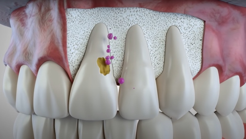 What is Resorption, and Why You Shouldn't Delay Treatment