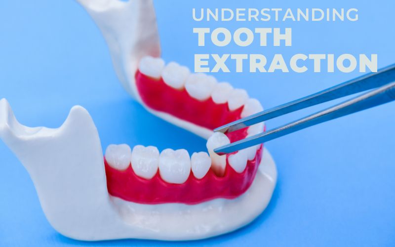 What Happens When Your Tooth Needs to be Extracted?